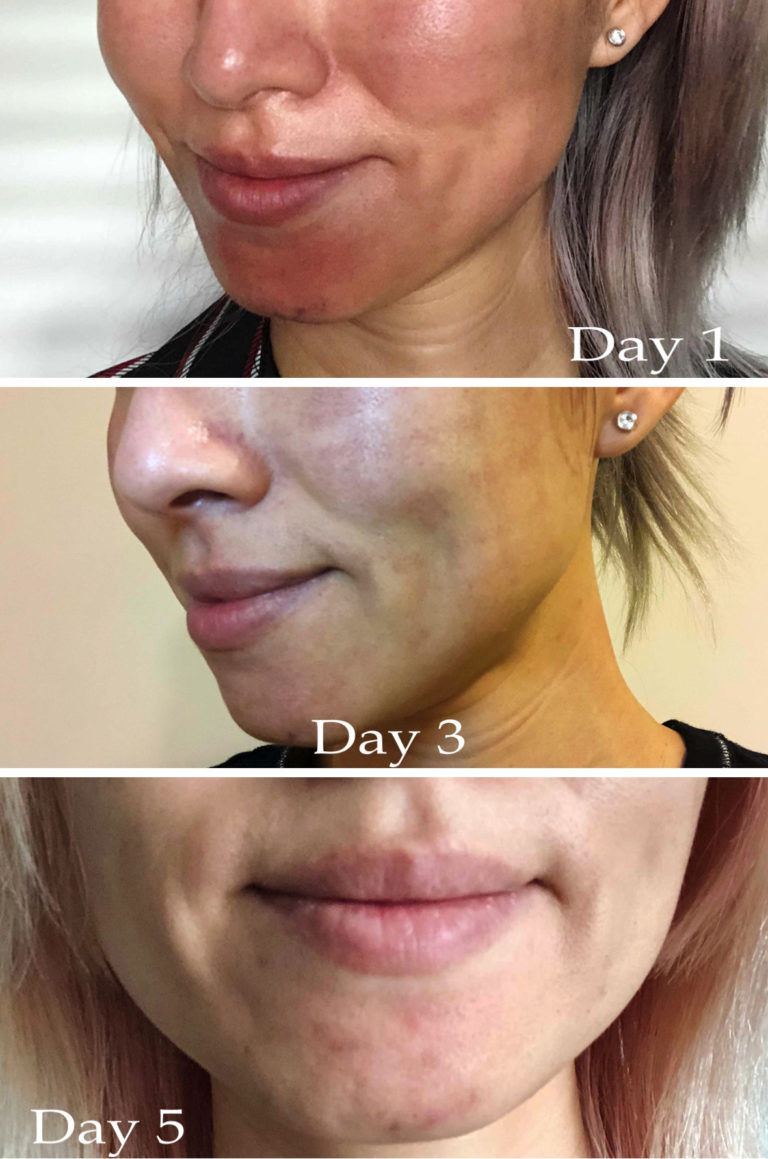 Fractional Co2 Laser Treatment - Tried And Tested - Stilettoes Diva Fractional Co2 Laser Treatment - Tried And Tested - Stilettoes Diva